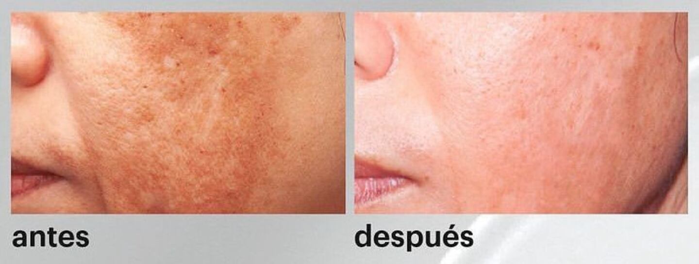 Transforma tu piel con Spot off: la técnica europea que elimina manchas ...