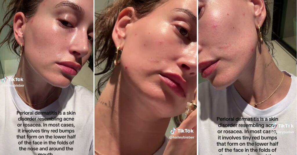 Hailey Bieber expone su rostro brotado por la dermatitis perioral ...